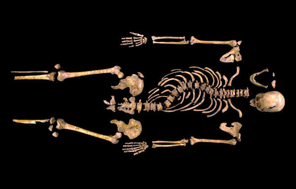 Richard Iii Skeleton Scoliosis